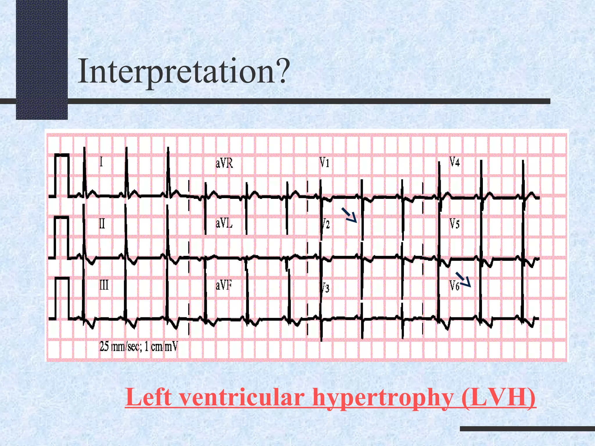 Pediatric ecg | PPT