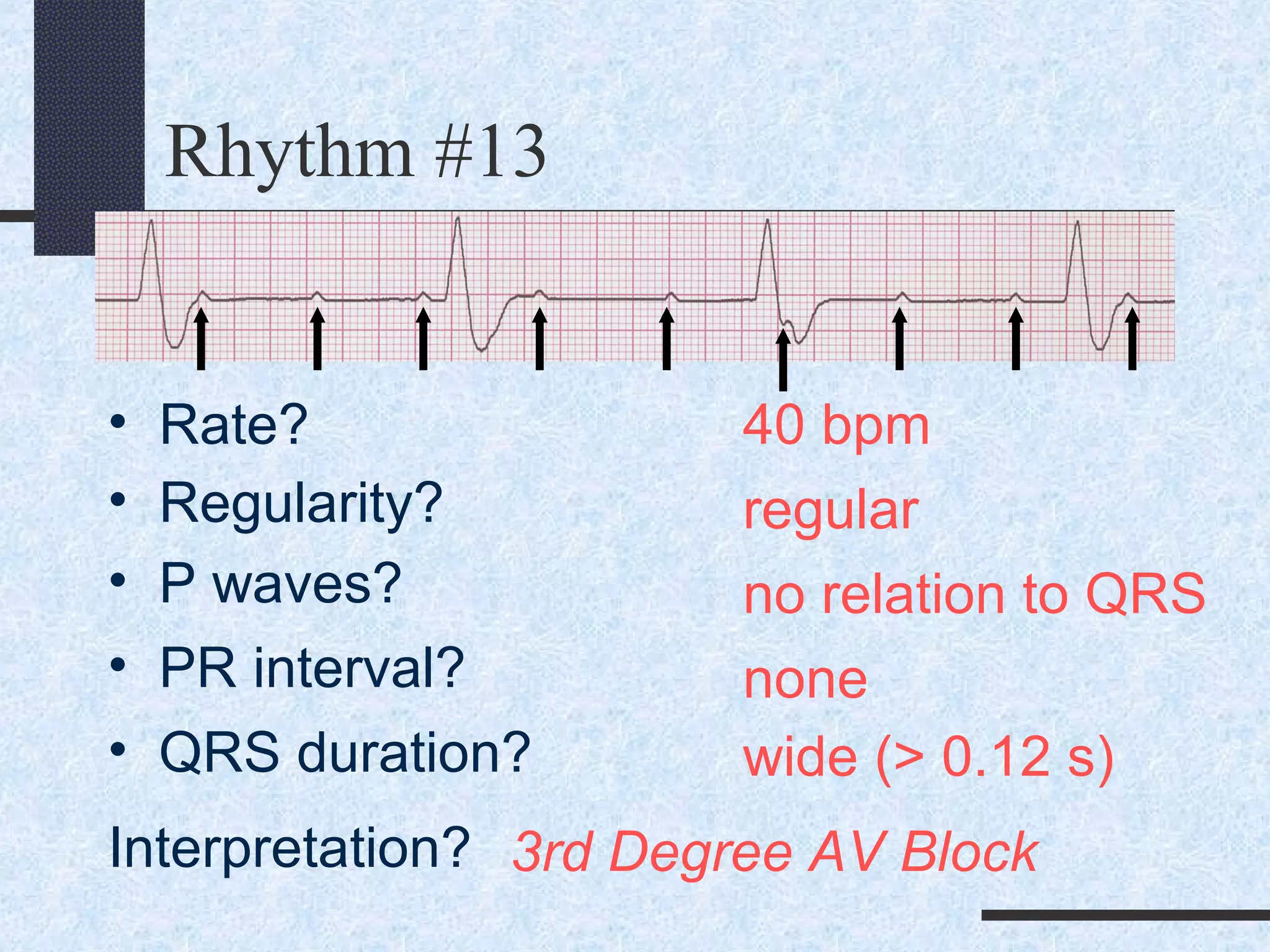 Pediatric ecg | PPT