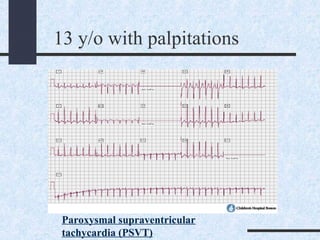 Pediatric ecg | PPT