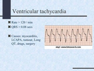 Pediatric ecg | PPT