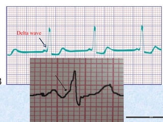 Pediatric ecg | PPT