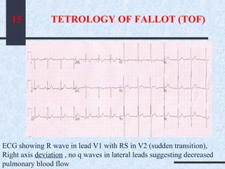 Pediatric ecg | PPT