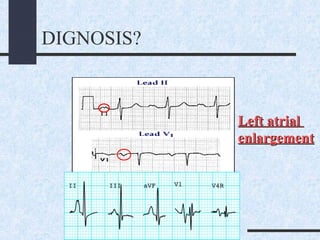 Normal Pediatric Ecg