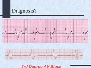 Normal Pediatric Ecg