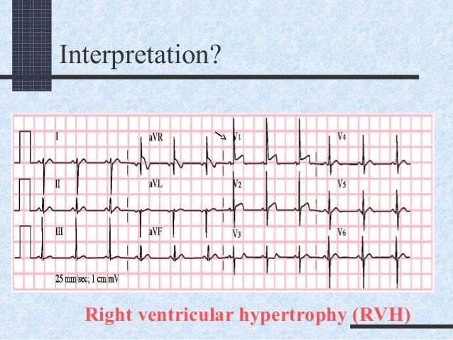 Pediatric ecg