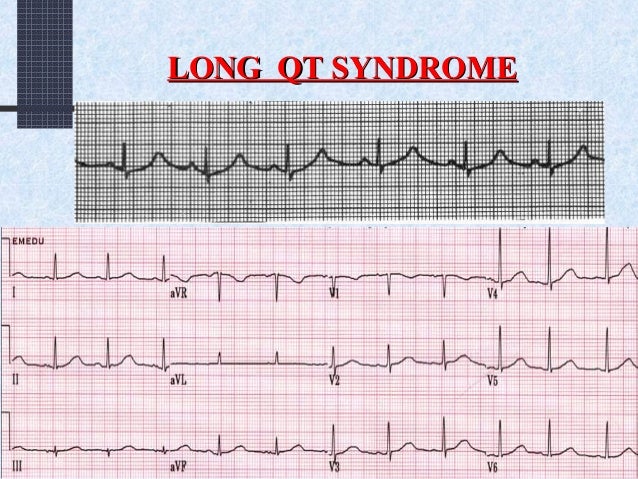 Pediatric ecg