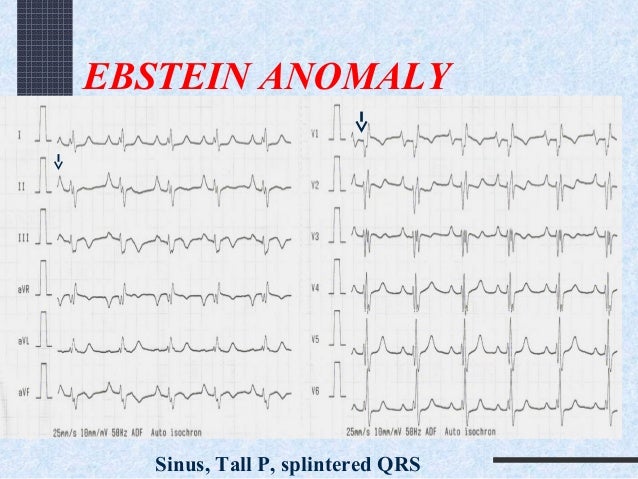 Pediatric ecg