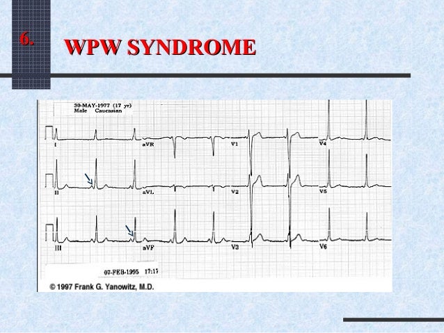 Pediatric ecg