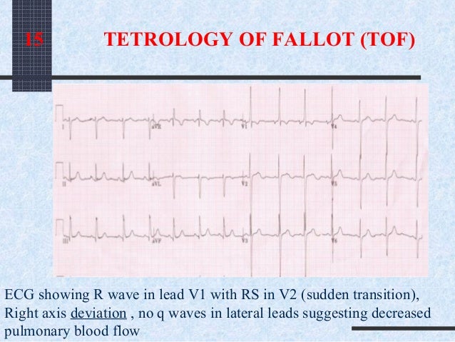 Pediatric ecg