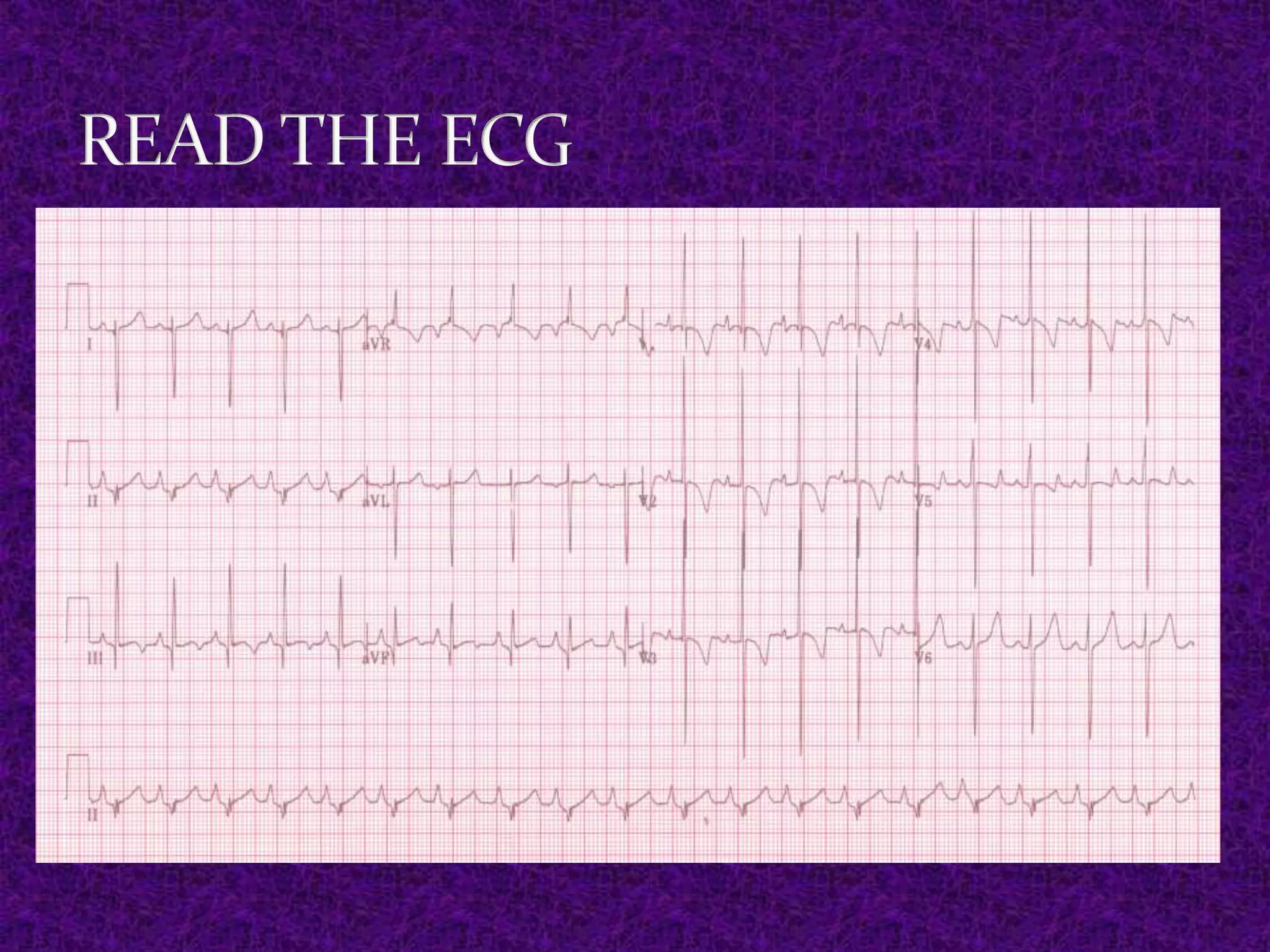 Pediatric ecg learning with quiz | PPT