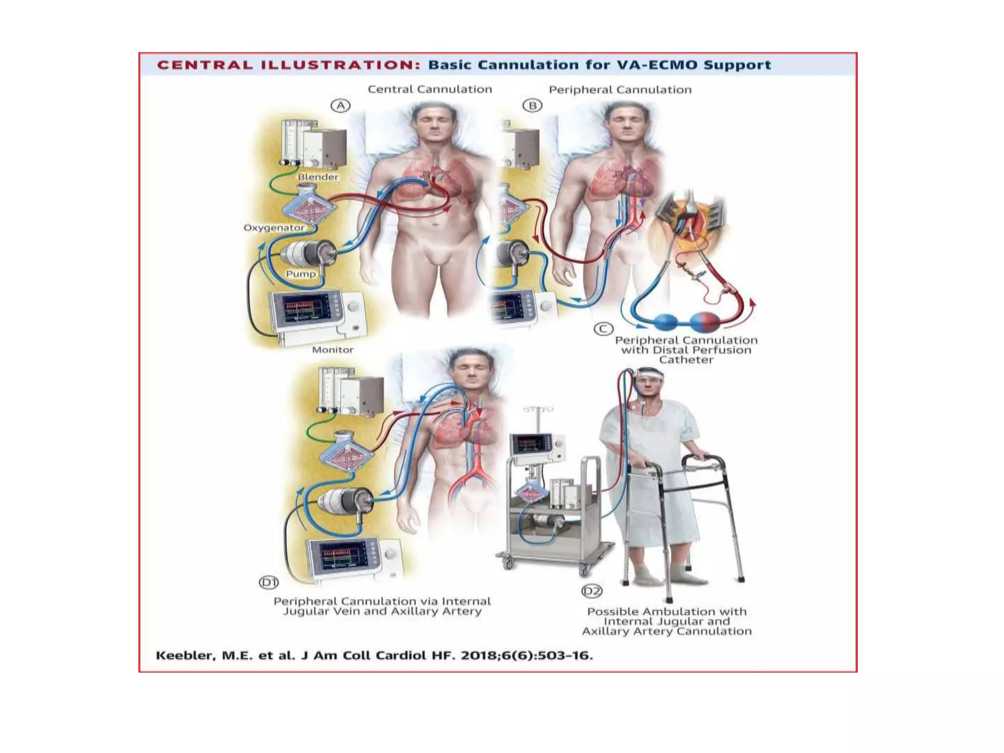 Pediatric ecmo | PPTX