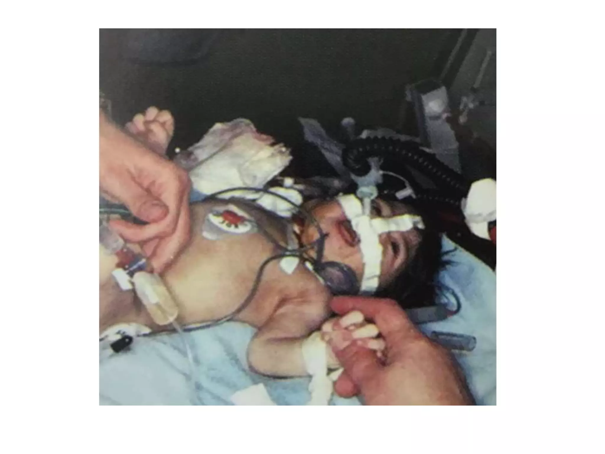 Pediatric ecmo | PPTX