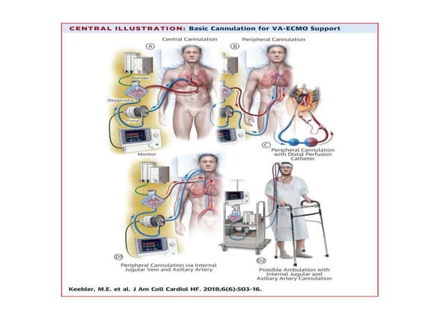 Pediatric ecmo | PPTX
