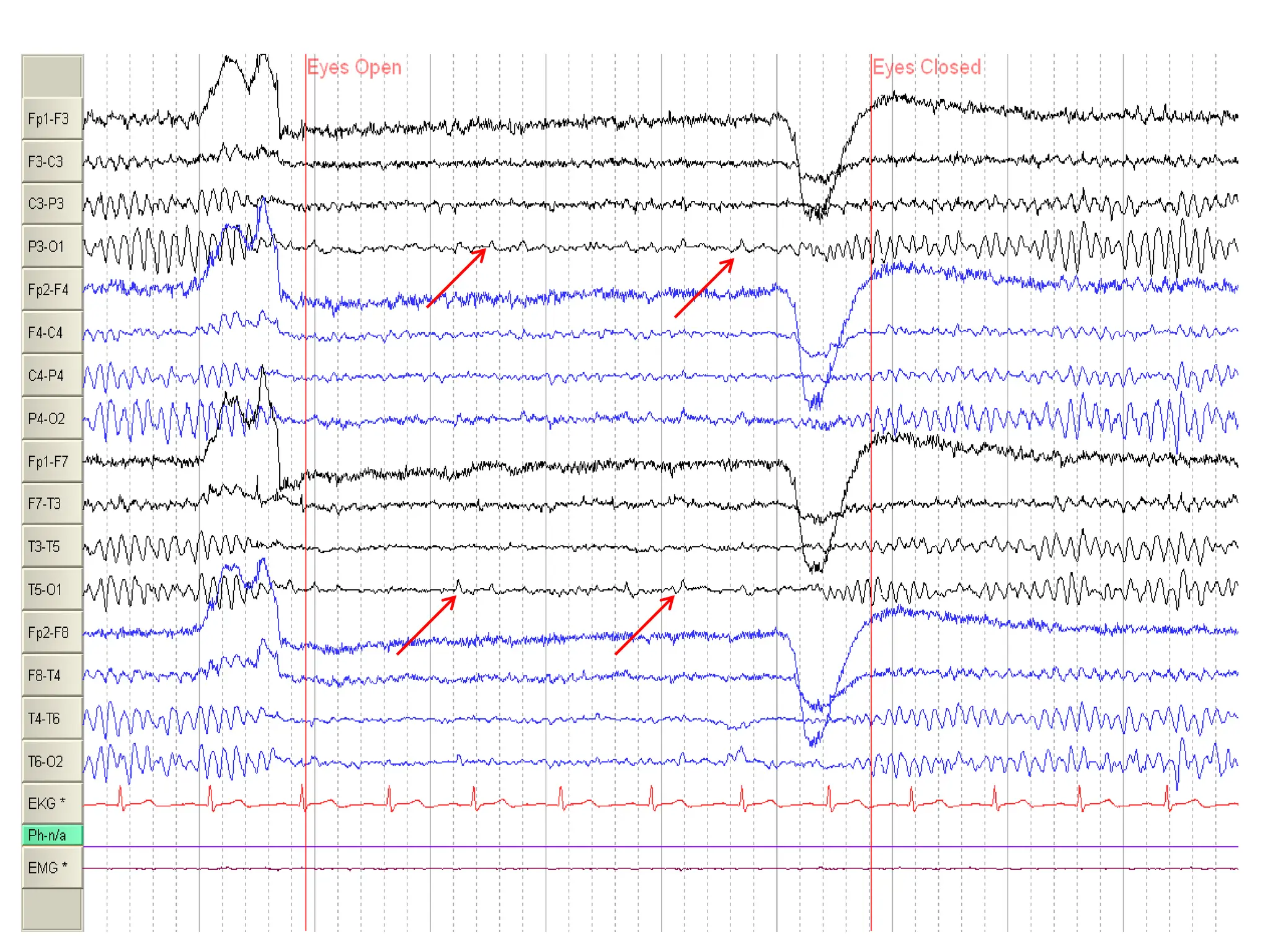 Pediatric EEG.pptx