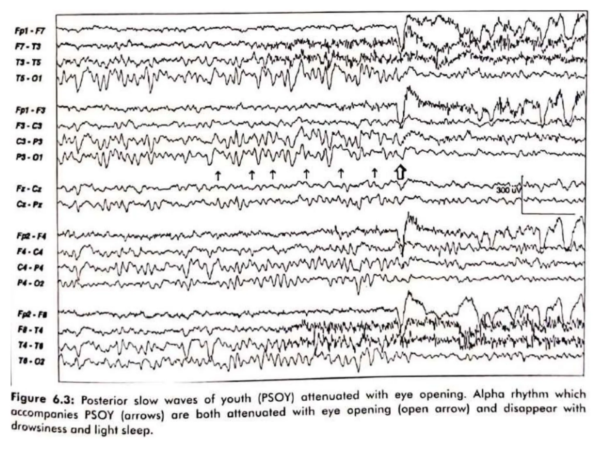 Pediatric EEG.pptx | Brain and Nervous System Disorders | Diseases and ...