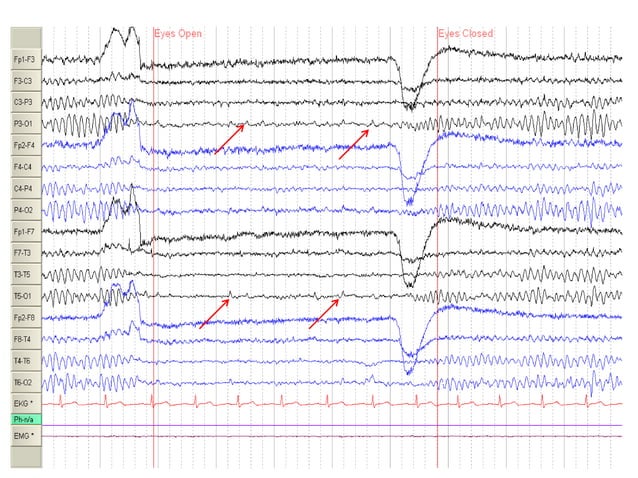 Pediatric EEG.pptx | Brain and Nervous System Disorders | Diseases and ...