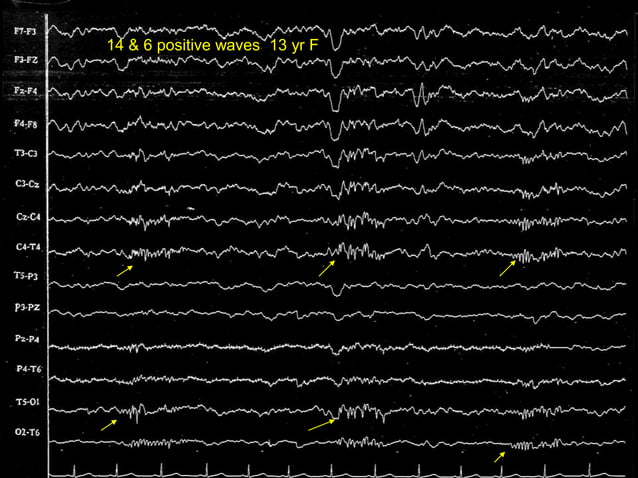 Pediatric EEG.pptx | Brain and Nervous System Disorders | Diseases and ...