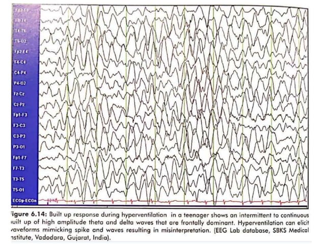 Pediatric EEG.pptx | Brain and Nervous System Disorders | Diseases and ...