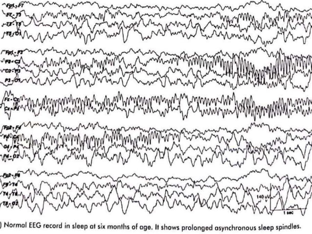 Pediatric EEG.pptx | Brain and Nervous System Disorders | Diseases and ...