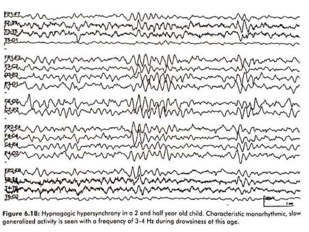 Pediatric EEG.pptx | Brain and Nervous System Disorders | Diseases and ...