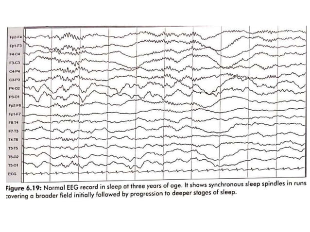 Pediatric EEG.pptx | Brain and Nervous System Disorders | Diseases and ...