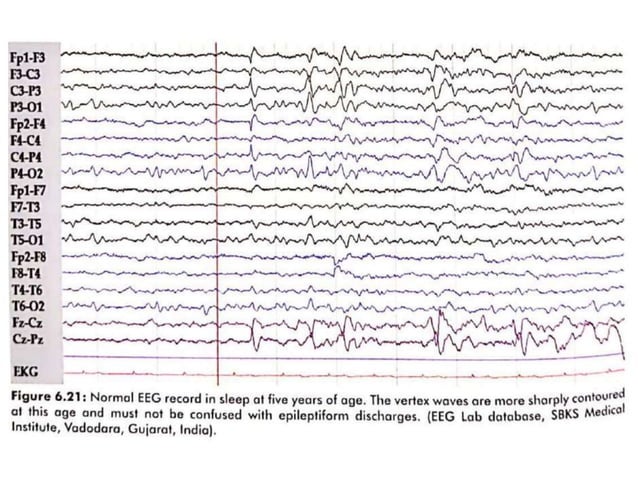Pediatric EEG.pptx | Brain and Nervous System Disorders | Diseases and ...