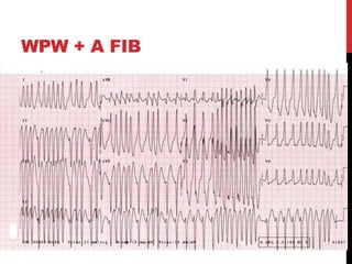 Pediatric EKGs | PPT