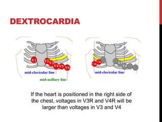 Pediatric EKGs | PPTX