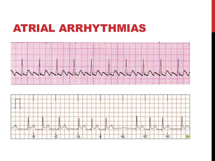 Pediatric EKGs