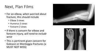 Pediatric Orthopedic Imaging Case Studies #7 Pediatric Elbow Fractures ...