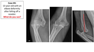 Pediatric Orthopedic Imaging Case Studies #7 Pediatric Elbow Fractures ...
