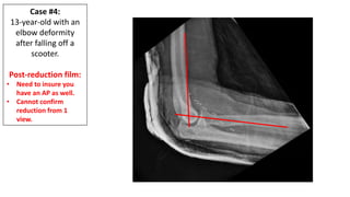 Pediatric Orthopedic Imaging Case Studies #7 Pediatric Elbow Fractures ...