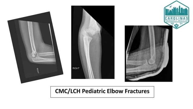 Pediatric Orthopedic Imaging Case Studies #7 Pediatric Elbow Fractures ...