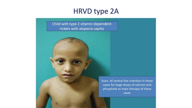Pediatric Endocrinology Review Part 3 Ppt