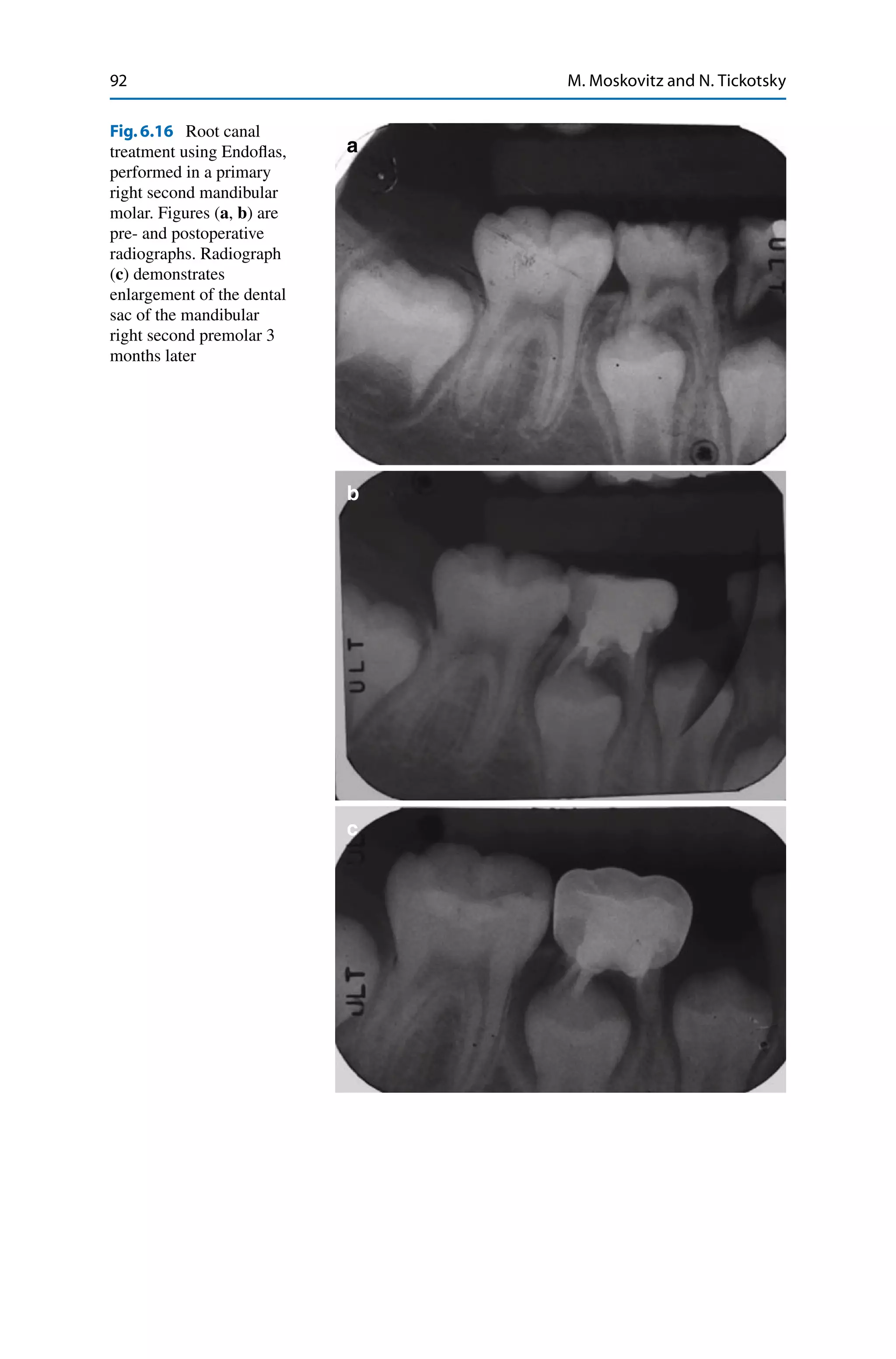Pediatric Endodontics_ Current Concepts in Pulp Therapy for Primary and ...