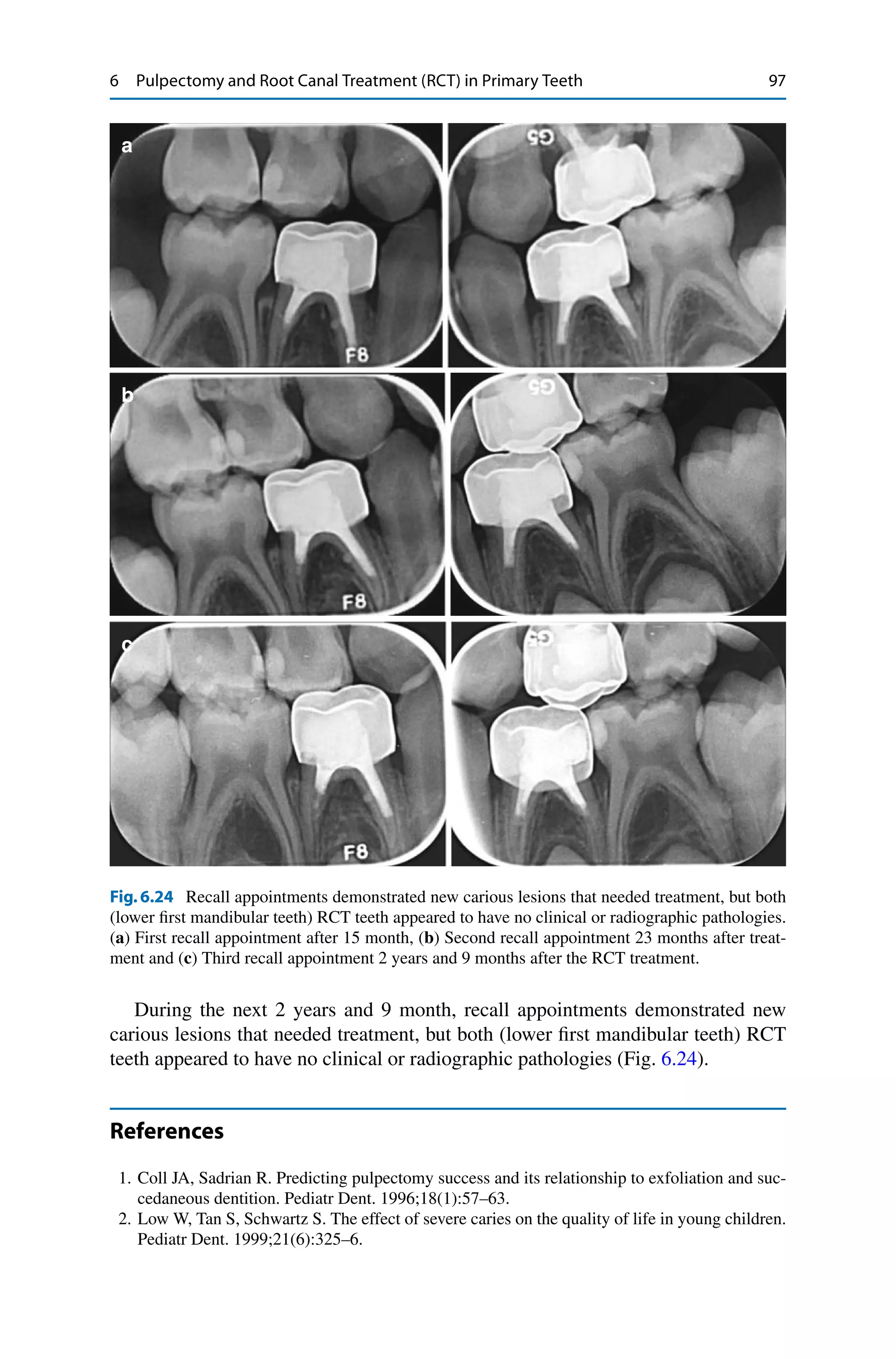 Pediatric Endodontics_ Current Concepts in Pulp Therapy for Primary and ...