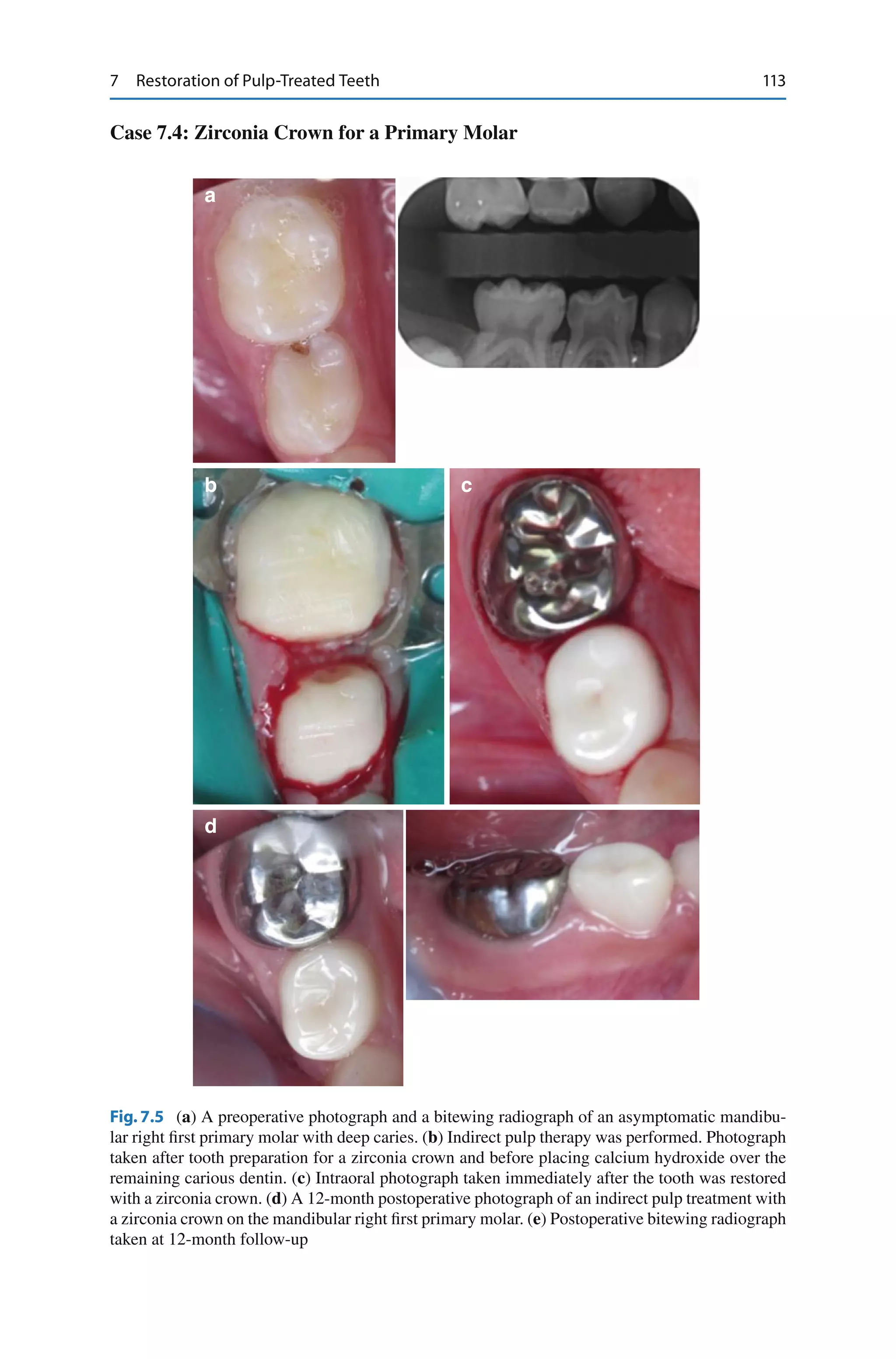 Pediatric Endodontics_ Current Concepts in Pulp Therapy for Primary and ...