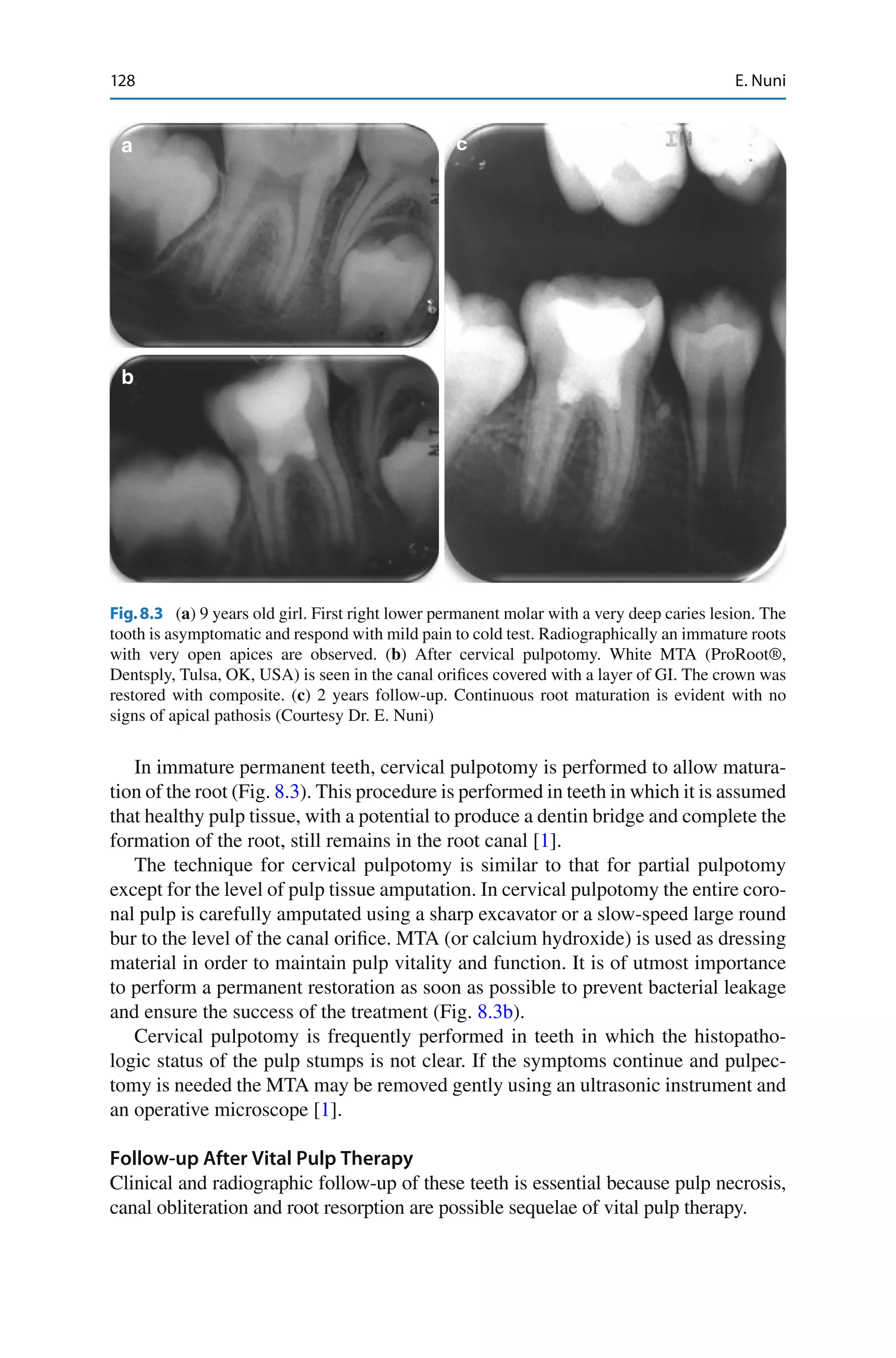 Pediatric Endodontics_ Current Concepts in Pulp Therapy for Primary and ...