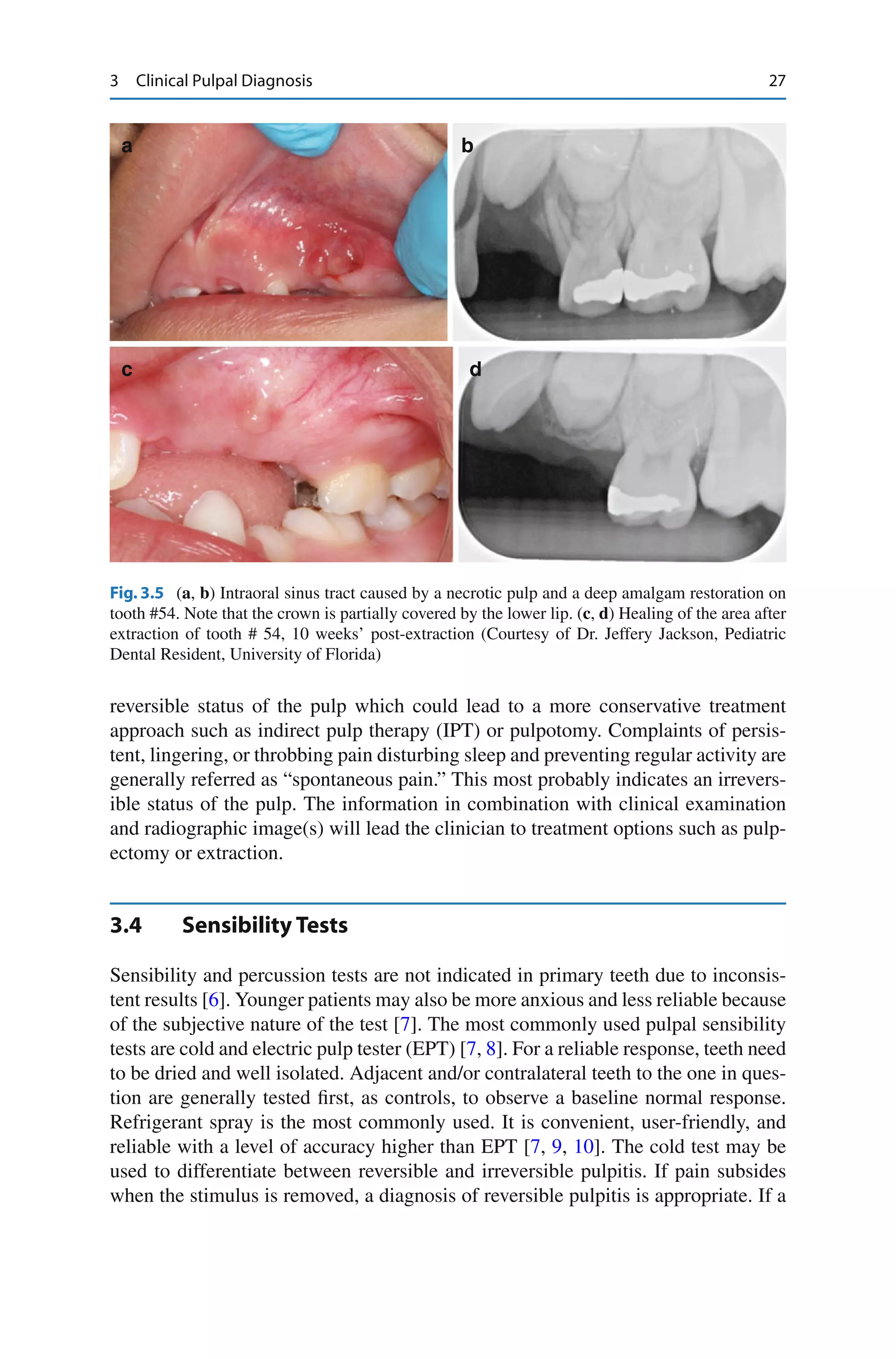 Pediatric Endodontics_ Current Concepts in Pulp Therapy for Primary and ...