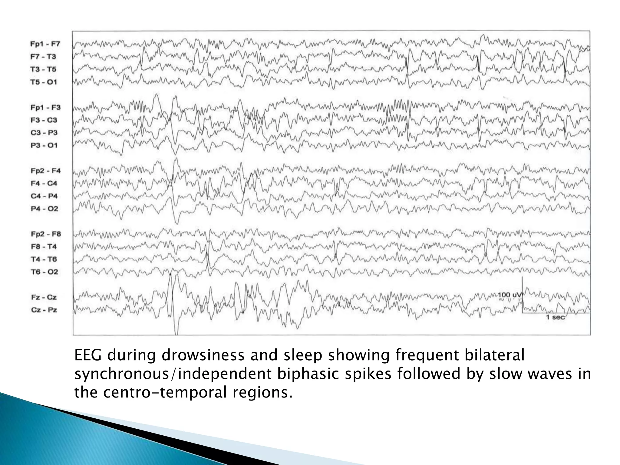Pediatric epilepsy syndromes | PPTX