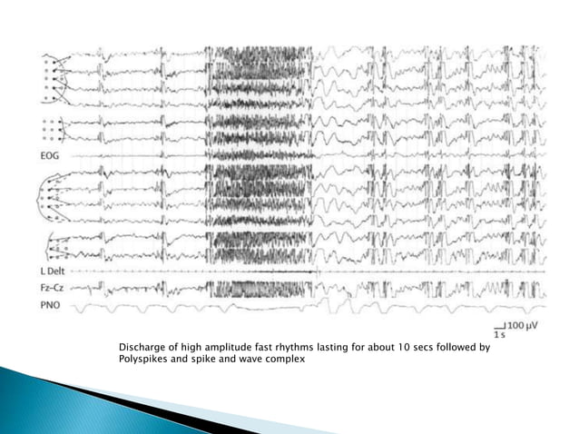 Pediatric Epilepsy Syndromes Ppt