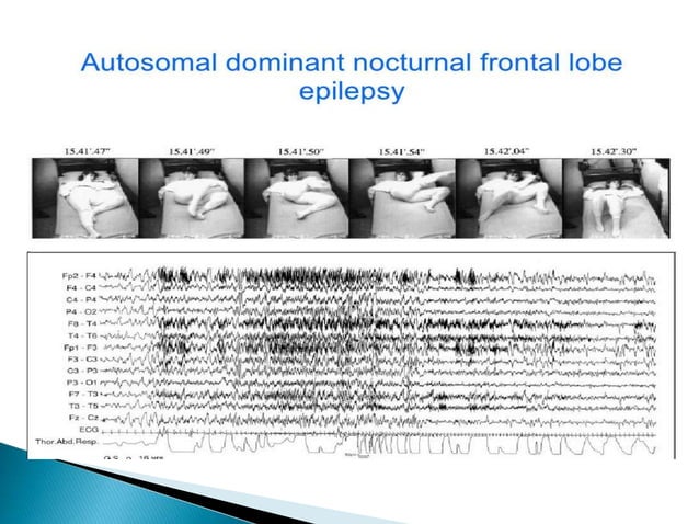 Pediatric Epilepsy Syndromes Ppt