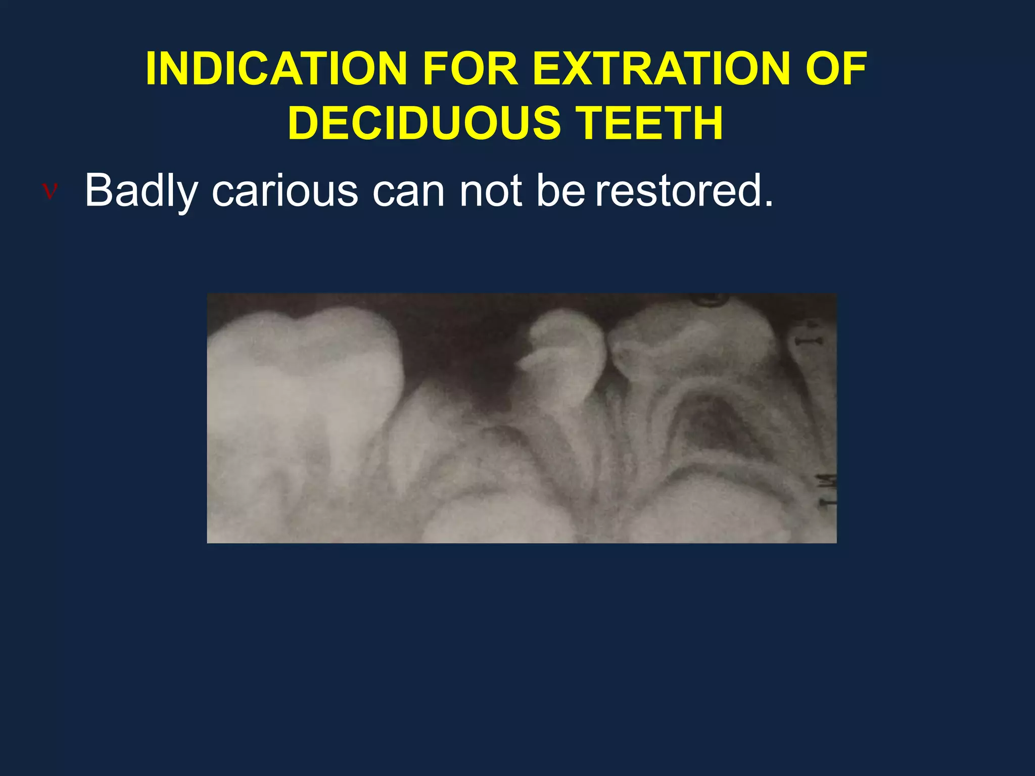Pediatric Exodontia.pptx