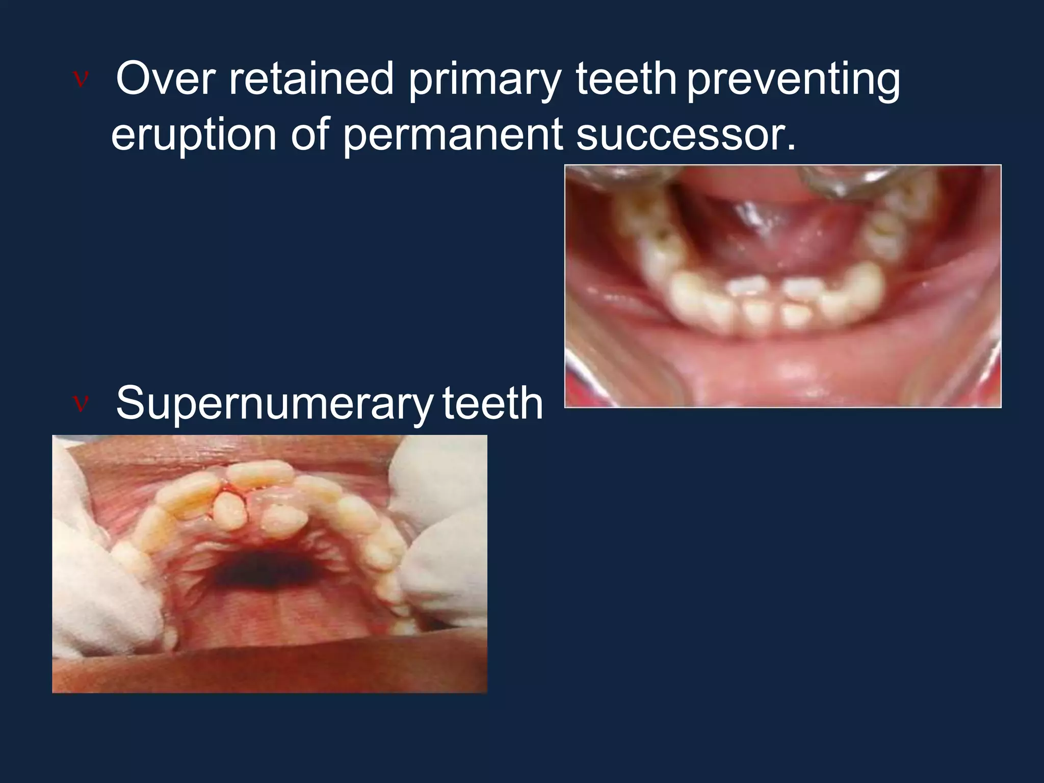 Pediatric Exodontia.pptx