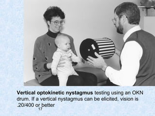Pediatric eye and vision | PPT