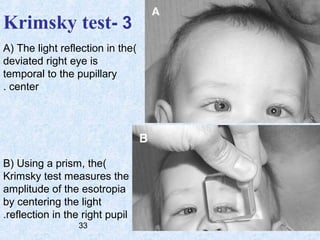 Pediatric eye and vision | PPT