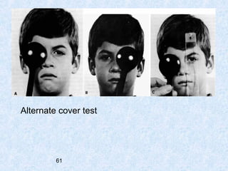 Pediatric Cover Test
