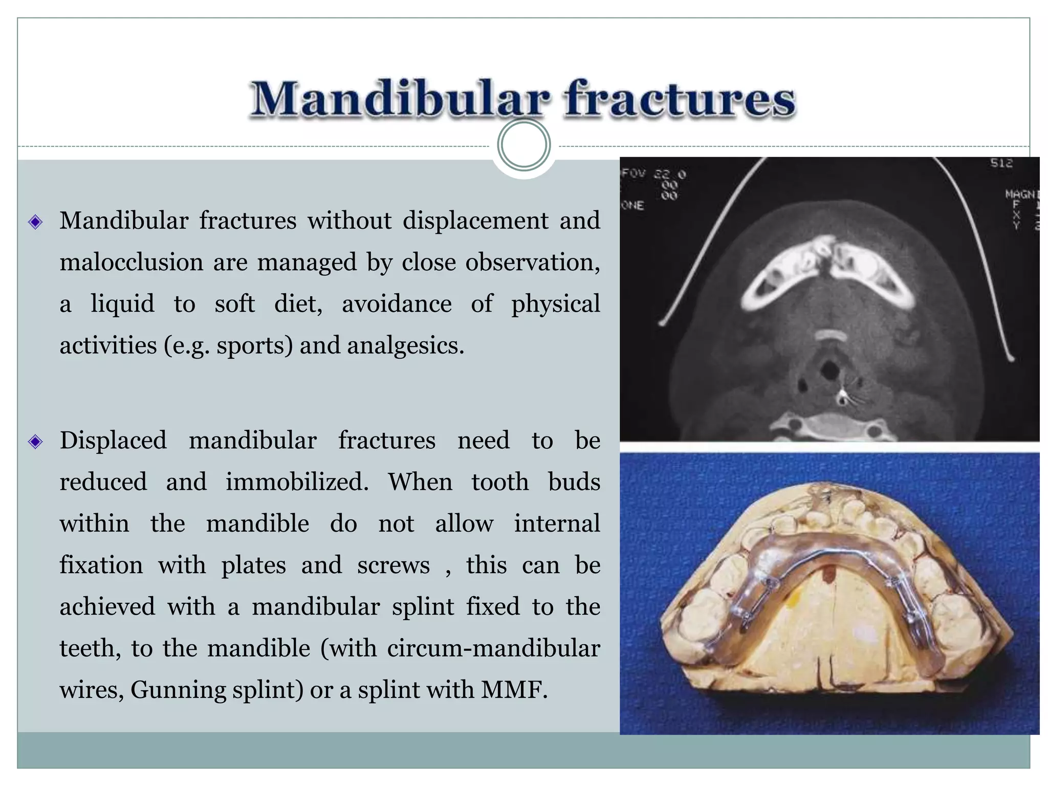 Pediatricfacialfractures 170101104439 | PPTX