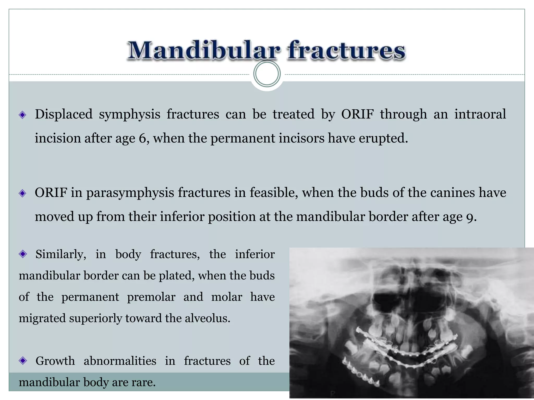 Pediatricfacialfractures 170101104439 | PPTX