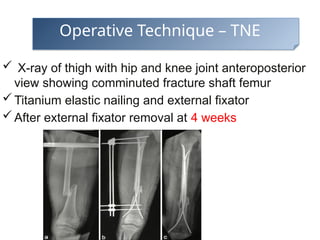 Pediatric_Femur_Fracture_Presentation.pptx